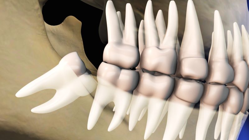 Does Everyone Have Wisdom Teeth?